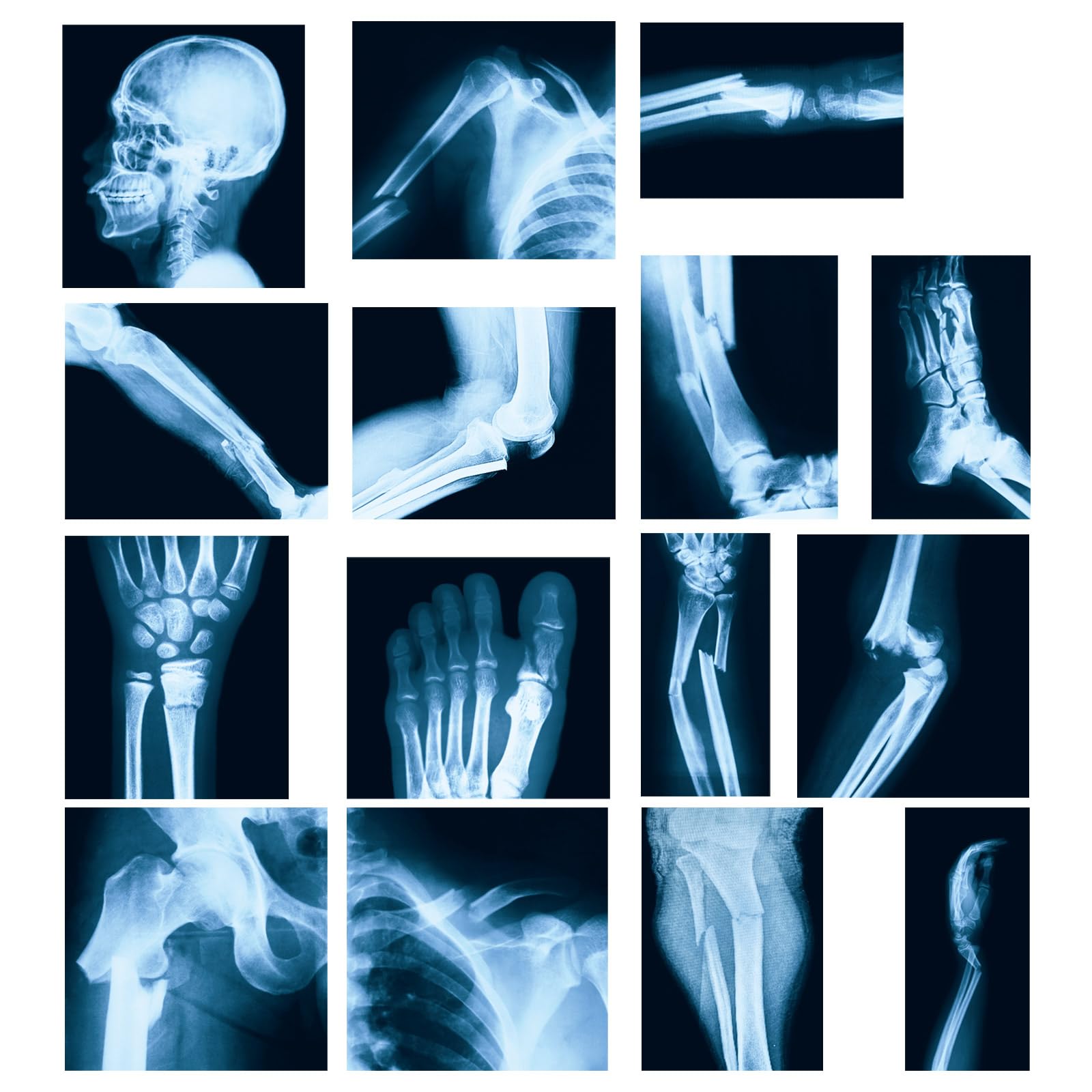Sayglossy 15 Pcs Broken Bones x Ray Set Human x Rays Black and Blue Sk ...